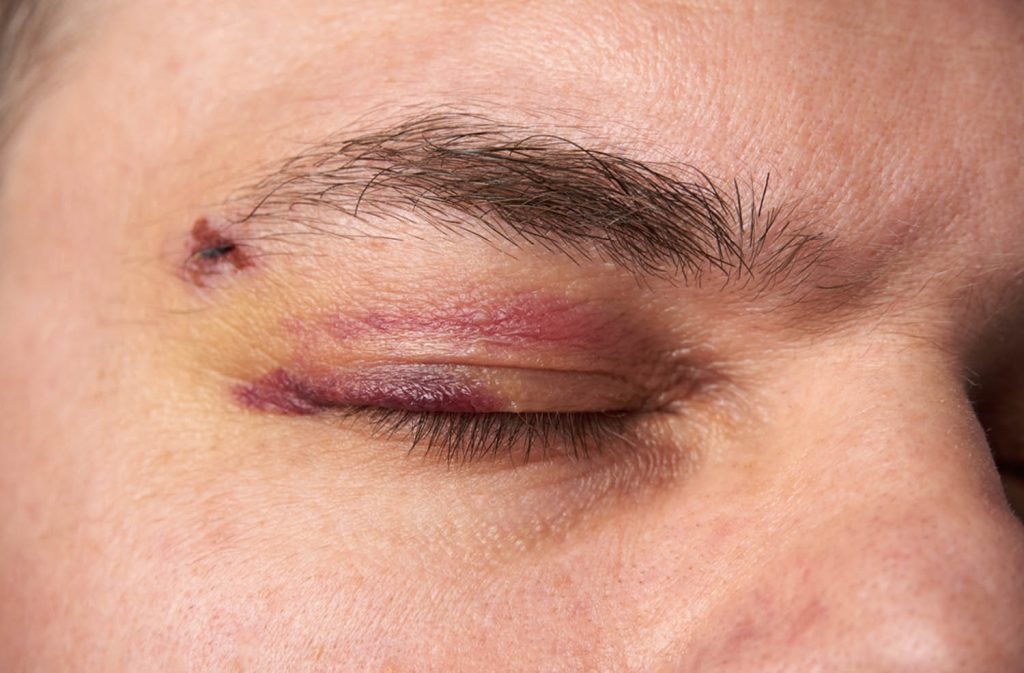 ¿Qué hacer en caso de trauma ocular?