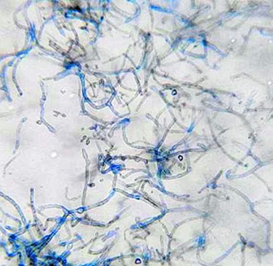 Temores y verdades sobre la mucormicosis (hongo negro)
