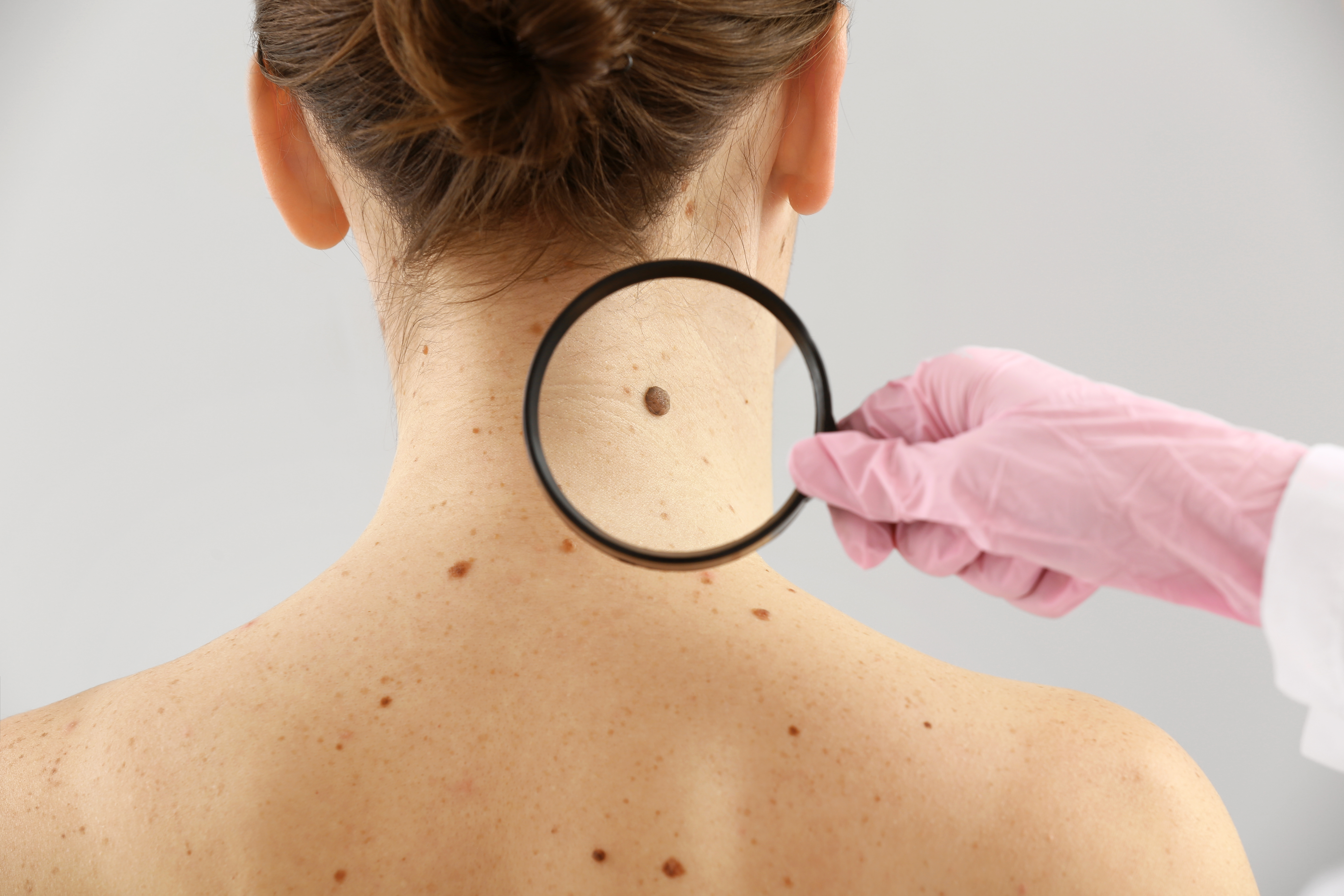 Tipos de celulitis: cómo identificar y tratar cada uno