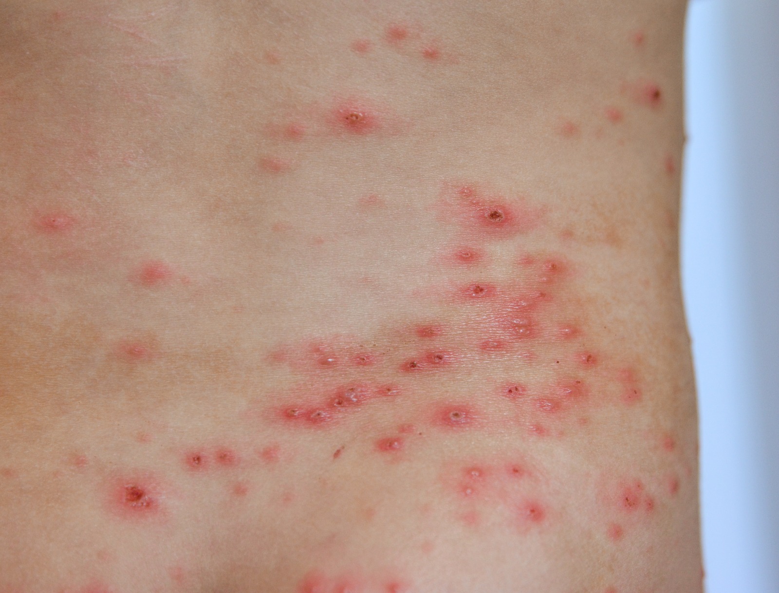 Varicela: qué es, cuáles son los síntomas y cómo curarla