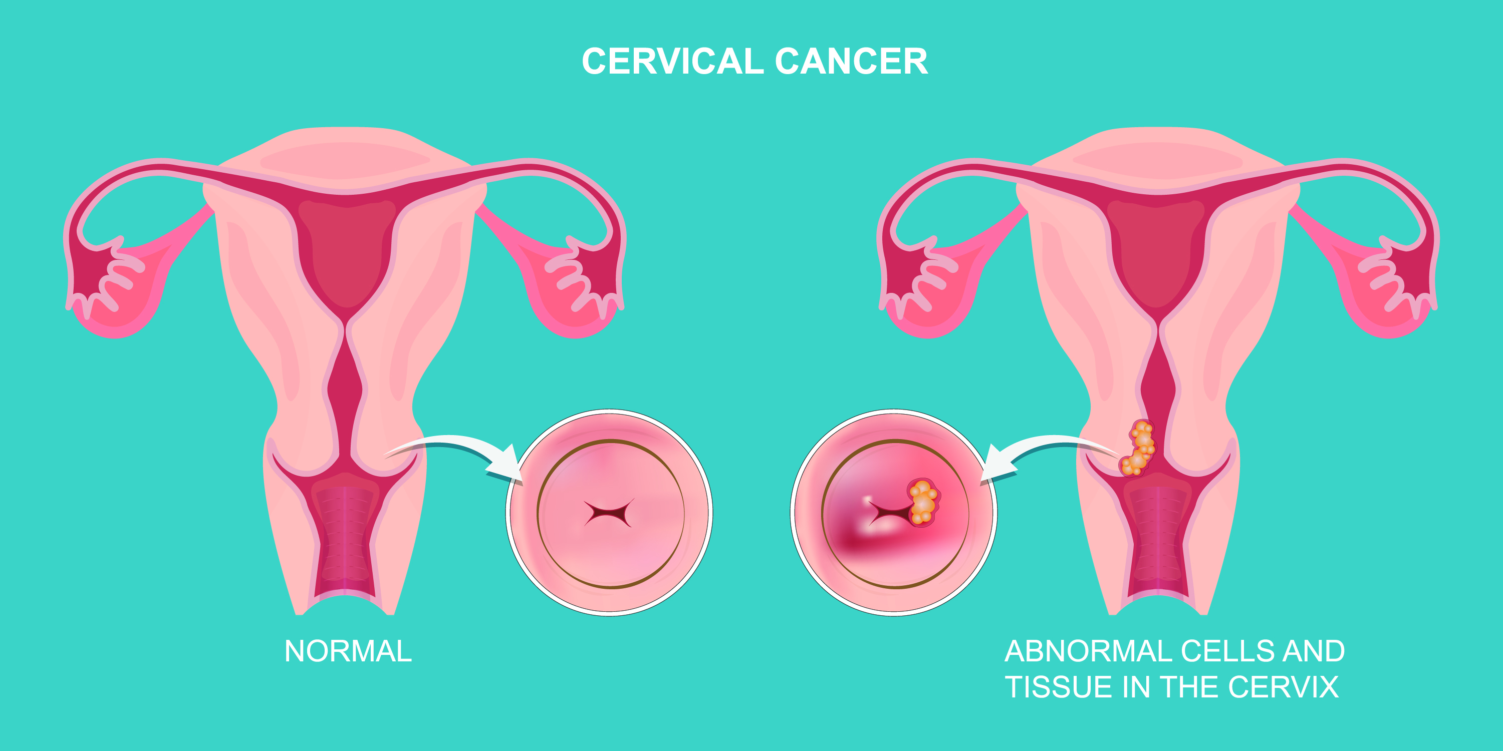 Qué es el cáncer de cérvix, cuáles son sus síntomas y cómo podemos ...